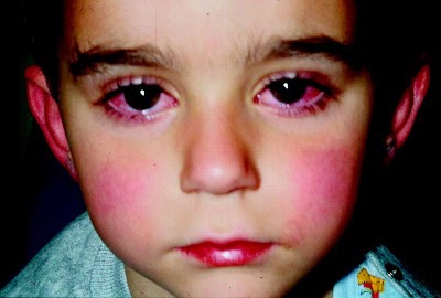Rheumatic Fever Symptoms In Children and Rheumatic Heart Disease | NCP Blog