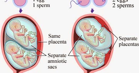 Twin Pregnancy အျမြာကိုယ္ဝန္
