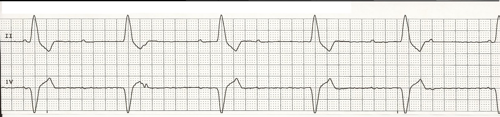 ACLS Rhythms: Heart blocks