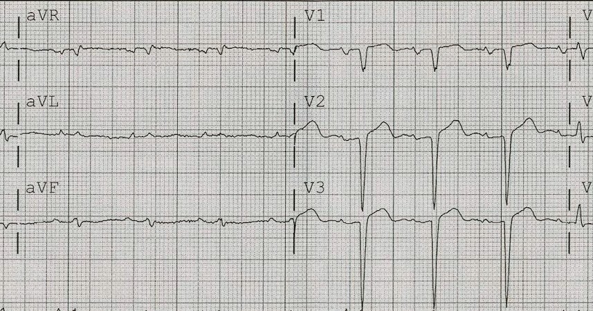 Dr. Smith's ECG Blog: Left ventricular Aneurysm Morphology Distorted by ...