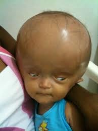 Patologias Humanas : Microcefalia