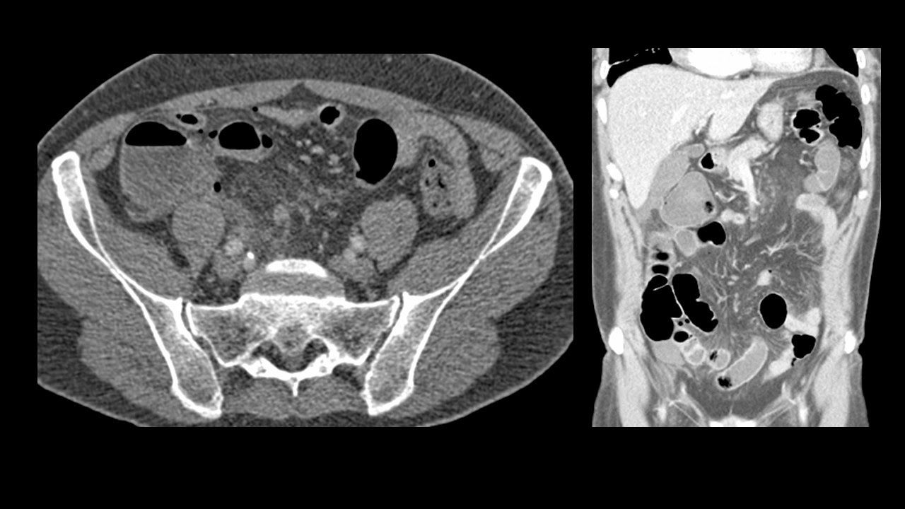 Casos de radiología de la Clínica Universidad de Navarra: Caso 227