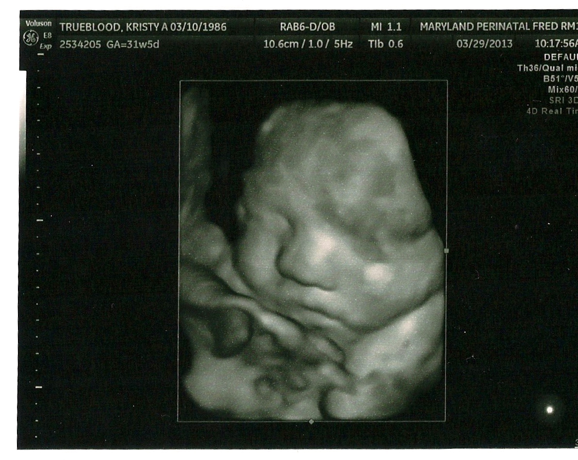 Jason and Kristy: 32 Week Growth Ultrasound