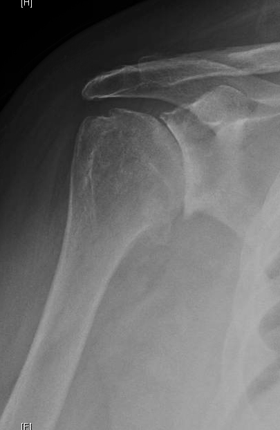 Shoulder Arthritis / Rotator Cuff Tears / Shoulder Pain : Managing ...