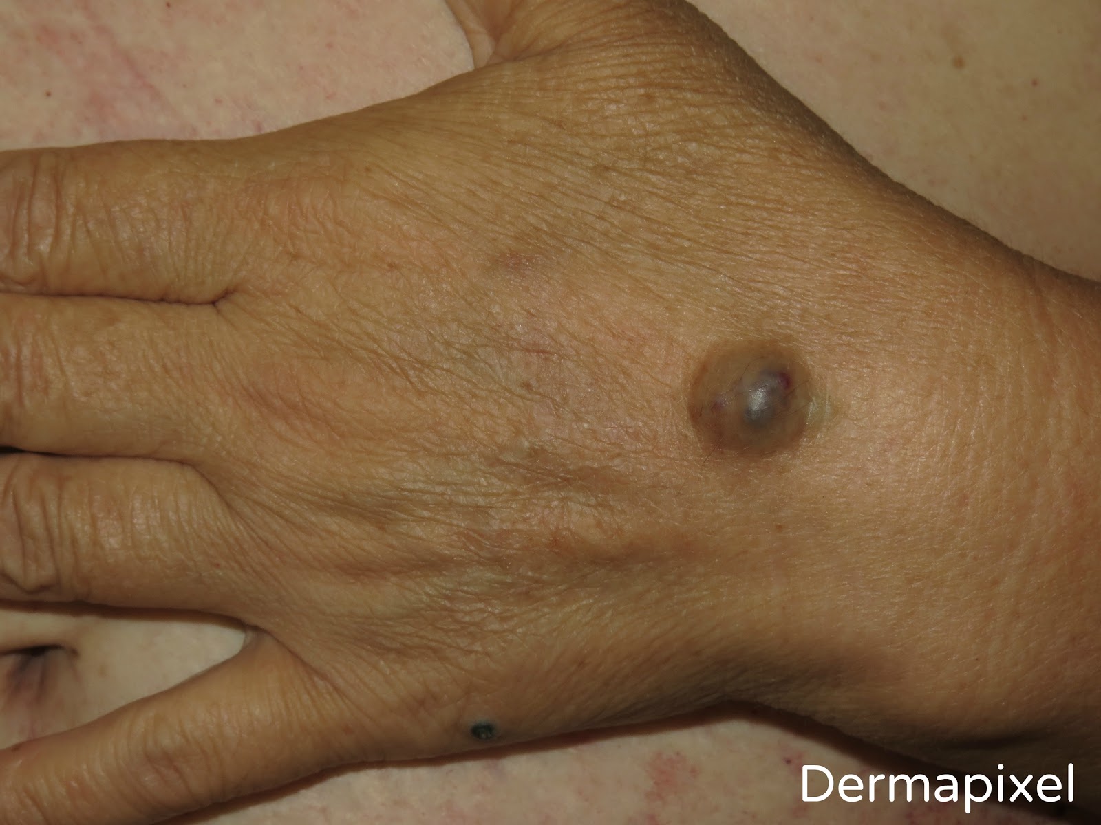 Dermapixel: septiembre 2017