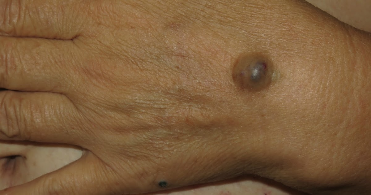 Dermapixel: Síndrome del nevus azul en tetina de goma: una causa de anemia