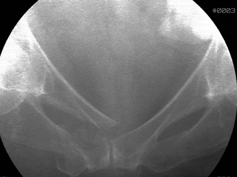 Case of the Month: Fracture cases at Harborview Medical Center ...