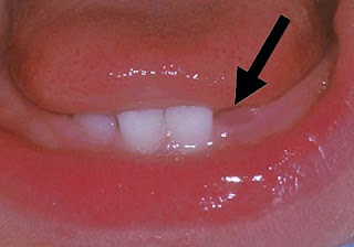 PORUR TOOTH CENTRE: Teething - Teething and Eruption