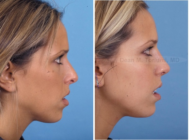 Dr. Dean Toriumi Reviews: Dean Toriumi: Secondary Rhinoplasty
