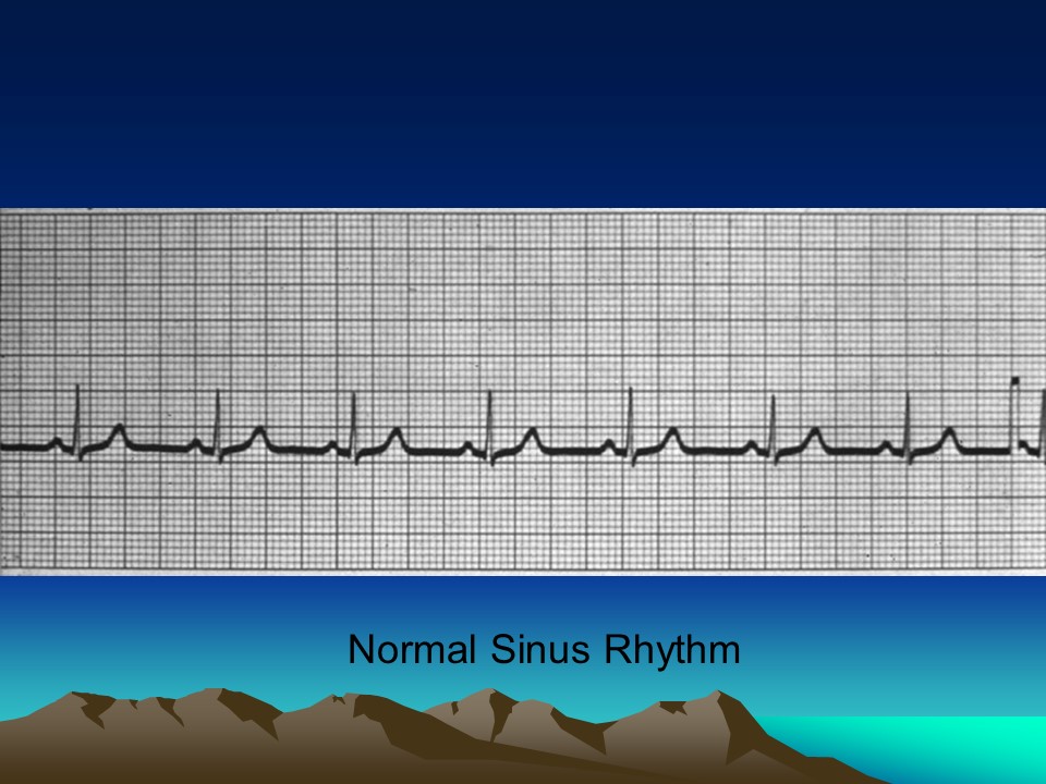 CVT Mohd Farid: Electrocardiogram ECG Part III Basic ECG Rhythm Pattern ...