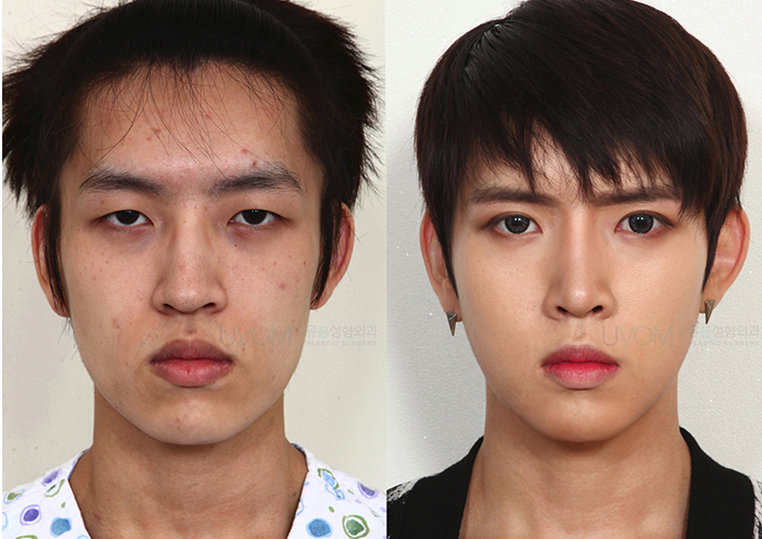 Korean Nose Job Men