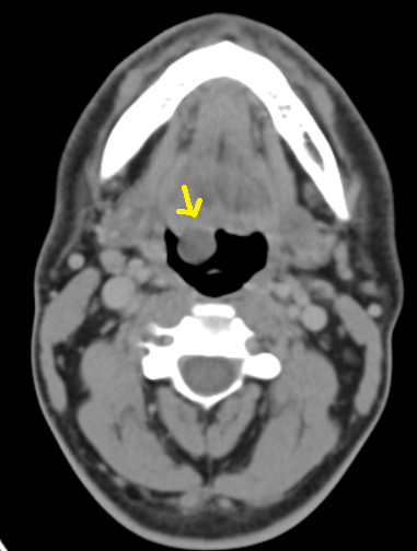 Vallecular Cyst-CT - Sumer's Radiology Blog