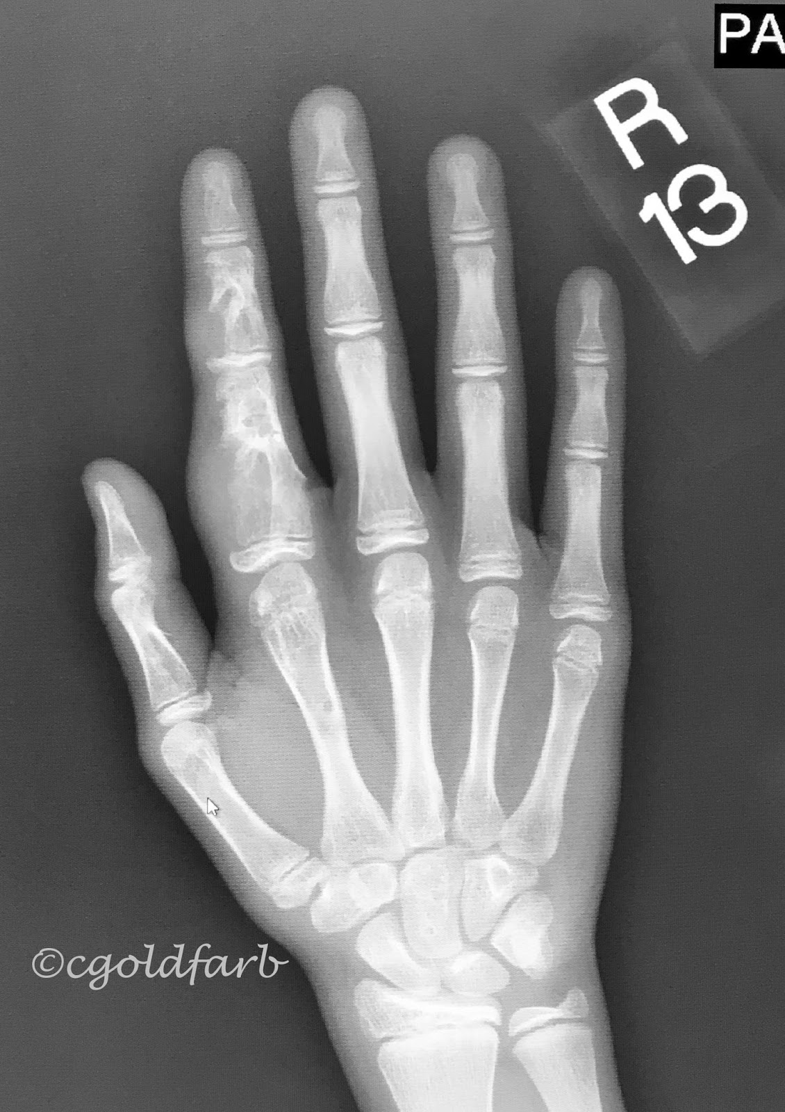 Surgery for Olliers Disease | Congenital Hand and Arm Differences ...