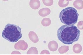 [Haematology] Abnormalities of the White Cell Series | Free Medical Atlas