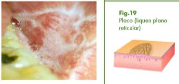 Ilian Nayelli : lesiones elementales