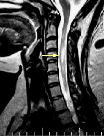 LESIÓN MEDULAR Y RIESGO DE PROGRESIÓN EN SÍNDROME RADIOLOGICAMENTE AISLADO