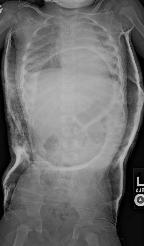 Spine Casting of Early-Onset Scoliosis | Growing Spine Blog ...