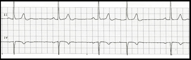 Float Nurse: Practice EKG Rhythm Strips 198