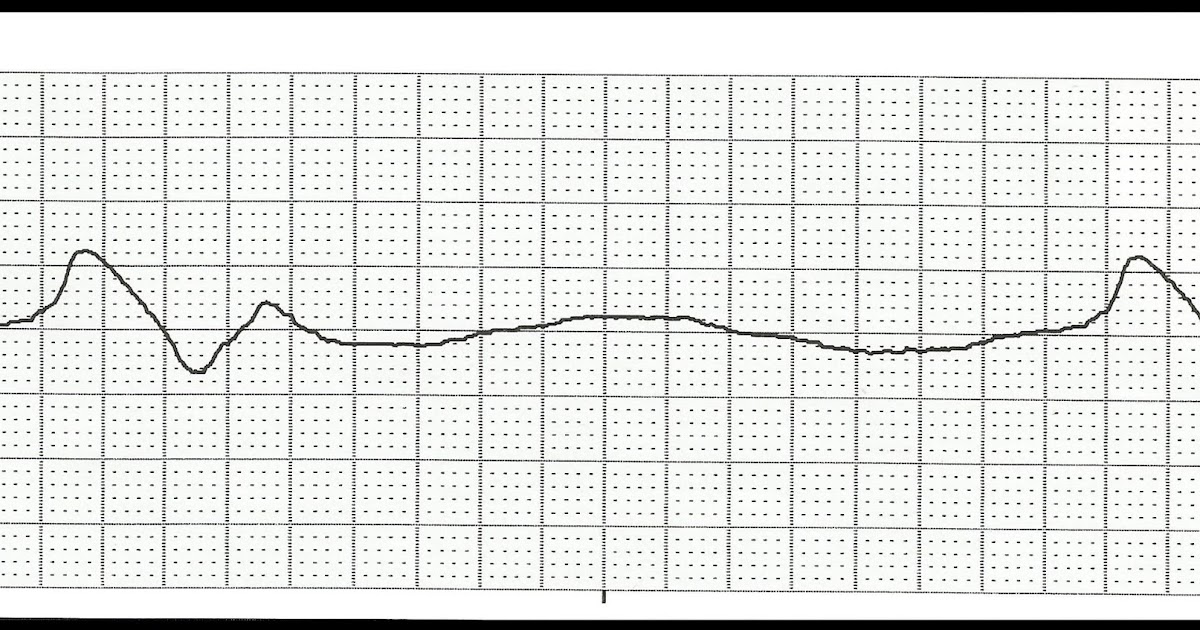 Ventricular rhythm Quiz 294