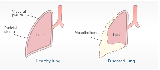 [pleural mesothelioma] provides accurate info exclusively for pleural ...