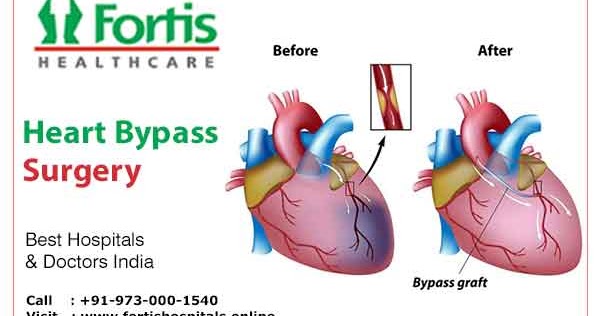 A Guide to Minimally Invasive Heart Bypass Surgery - Fortis Hospitals