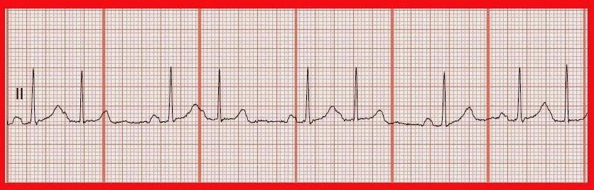 Various Rhythms with PACs
