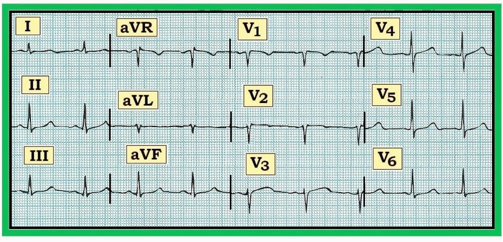 ECG Interpretation: ECG Interpretation Review #82 (Acute STEMI – RCA ...