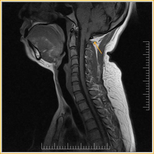 Chiari I malformation - Sumer's Radiology Blog