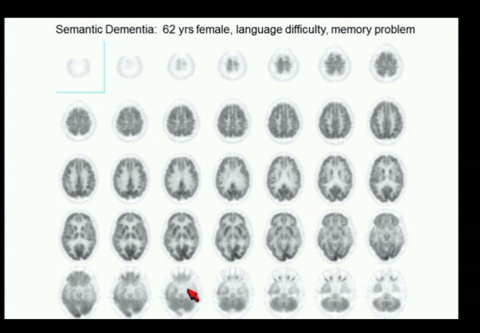 rsna: FDG PET for dementia