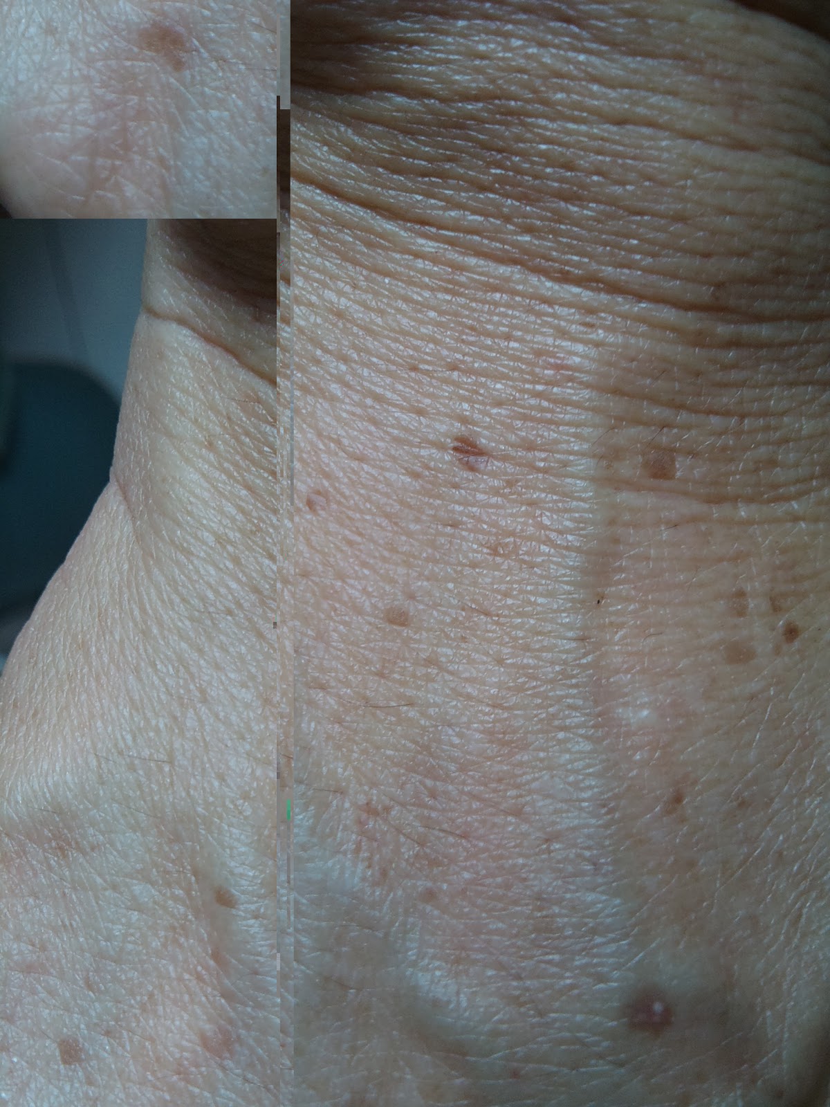 I Live In KK: Old Age Spot/Liver Spot