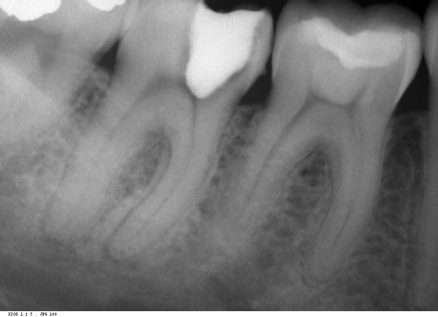 Pulpitis - e-Medical