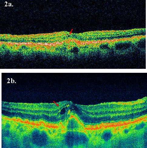 DEGENERACION MACULAR : DMAE SECA. OCT DE CONTROL