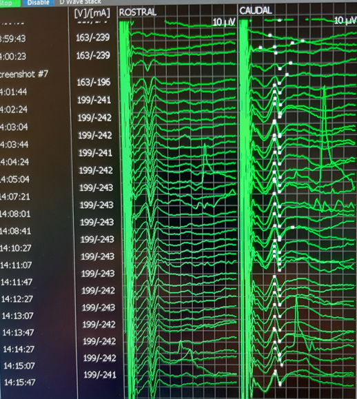 Neurophysiology Plus Iceland: D wave IONM in Iceland. Third case ...