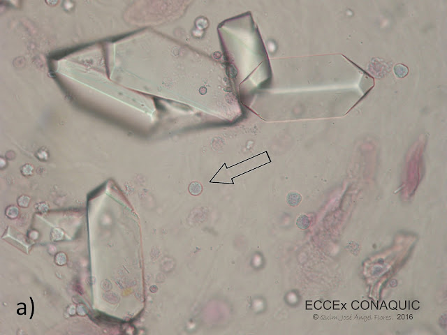 Caso UR-agosto-16 (Enfoque: Cristaluria)