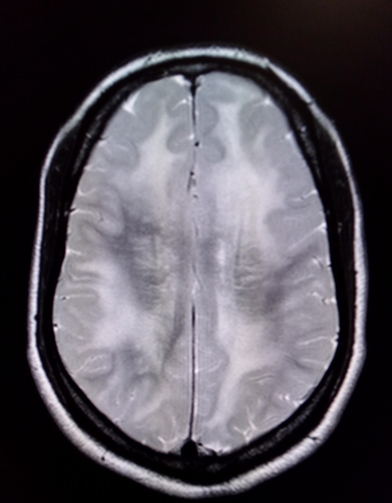 Progressive Multifocal Leukoencephalopathy: MRI - Sumer's Radiology Blog