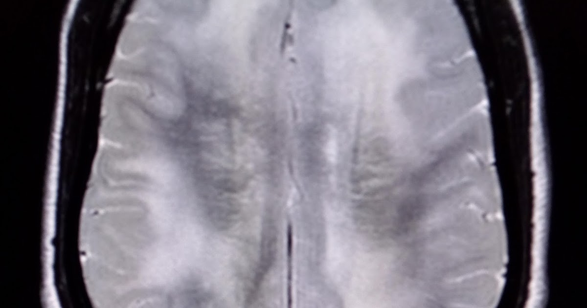 Progressive Multifocal Leukoencephalopathy: MRI - Sumer's Radiology Blog