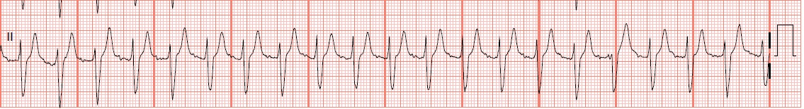 EKG Rhythm Strips: Hyperkalemia part 1