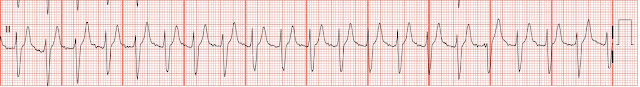 EKG Rhythm Strips: Hyperkalemia part 1