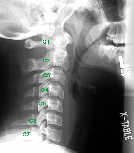 Blanco Studio Pilates: Cervicalgia e a Intervenção do Pilates