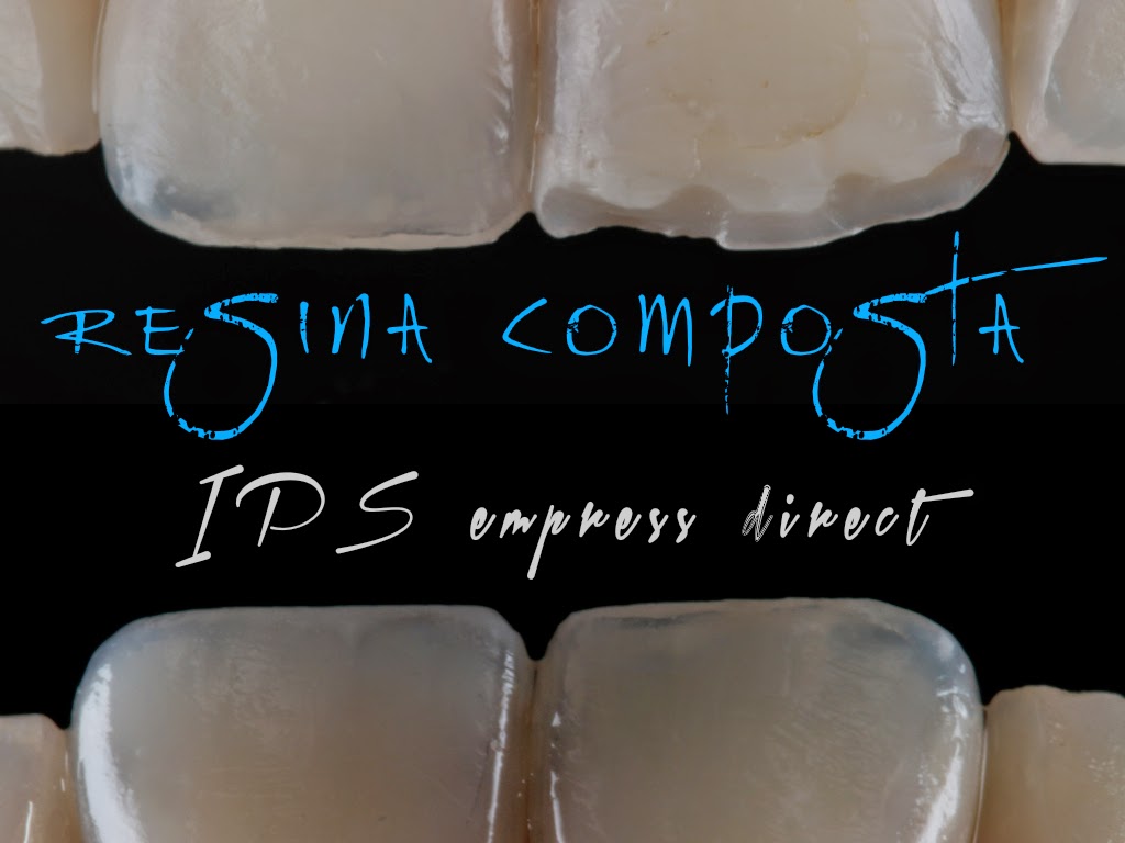 Tendências em Odontologia Estética: Resinas compostas - DETALHES ...