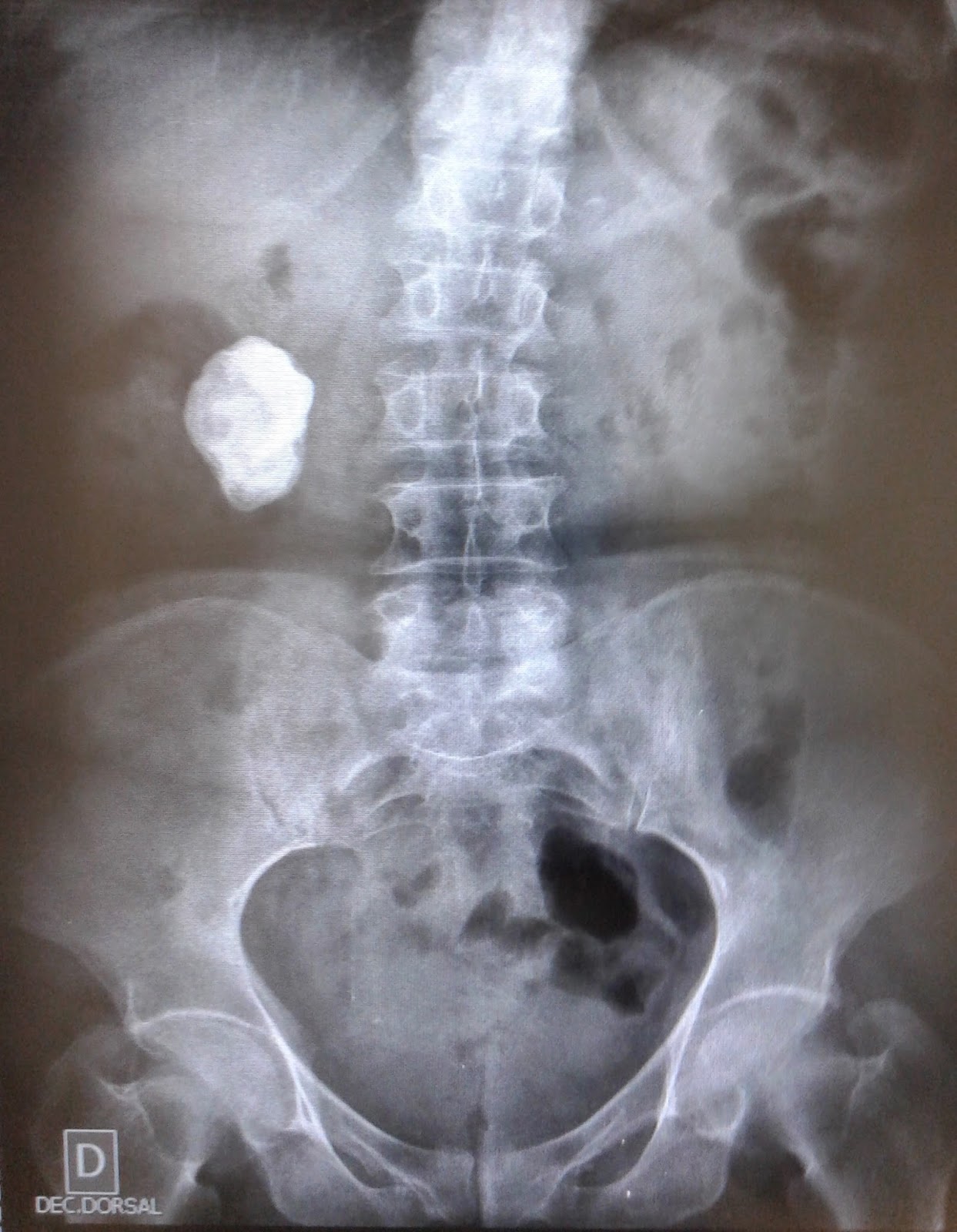 DICAS DE RADIOLOGIA: IMAGENS RADIOLÓGICAS - CÁLCULO RENAL