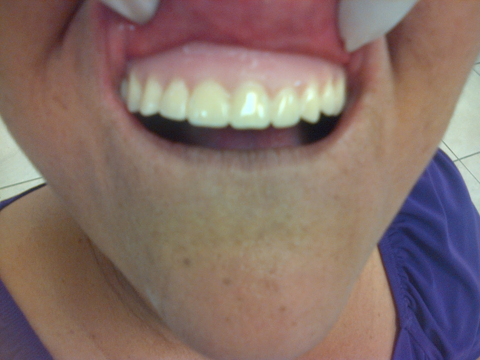 odontologia: caso clinico de protesis total