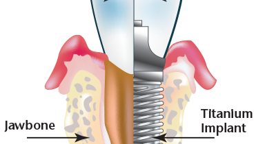 do dental implants mimic natural teeth?