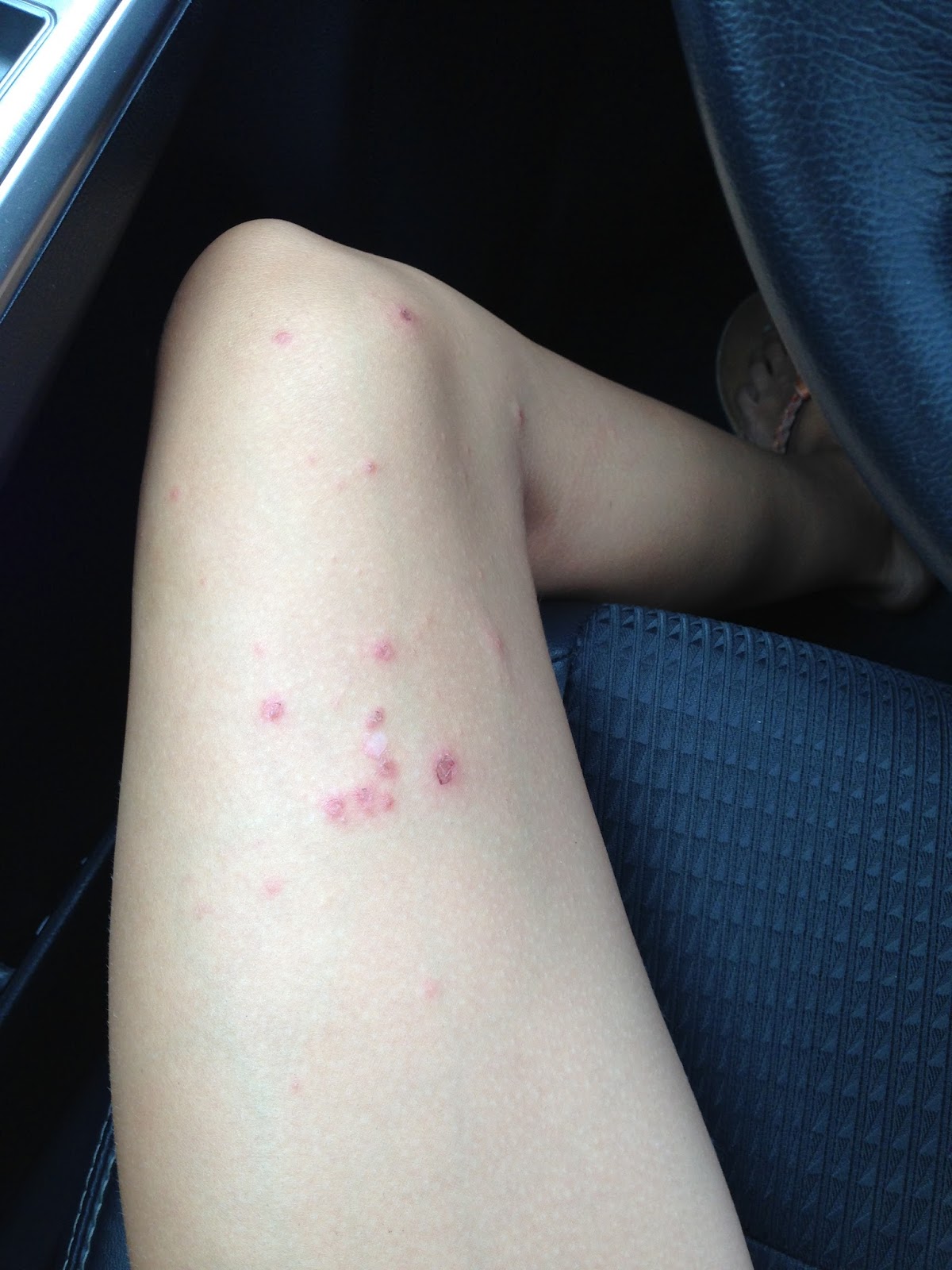 Self Image | Battle with PLEVA | 17freckles