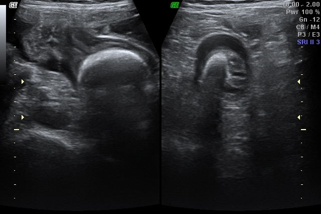 FOCAL SMALL BOWEL STRICTURE WITH SAIO & ENTEROLITHS - Sumer's Radiology ...
