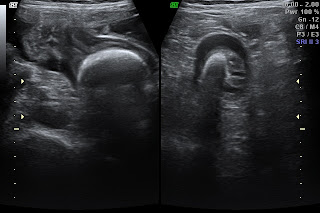 FOCAL SMALL BOWEL STRICTURE WITH SAIO & ENTEROLITHS - Sumer's Radiology ...