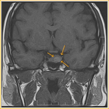 Rathke's Cleft Cyst :MRI - Sumer's Radiology Blog
