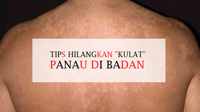 3 Petua Mudah Untuk Merawat Panau - Tazkirah Daily