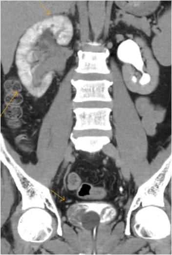 Acute Pyelonephritis-CT - Sumer's Radiology Blog