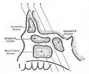UPDATE ! Tanda dan Gejala Sinus Akut serta Pengobatan Lini Pertama dan ...